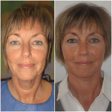Mid Facelift cheek lift Dubai & Abu Dhabi - Best Surgeons