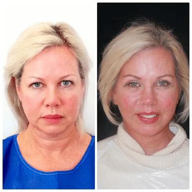 Mid Facelift cheek lift Dubai & Abu Dhabi - Best Surgeons