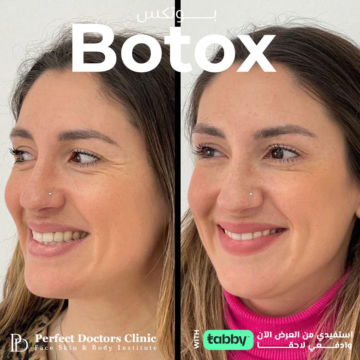 Botox Injections Treatments in Dubai Abu Dhabi - Best Botox Clinic ...