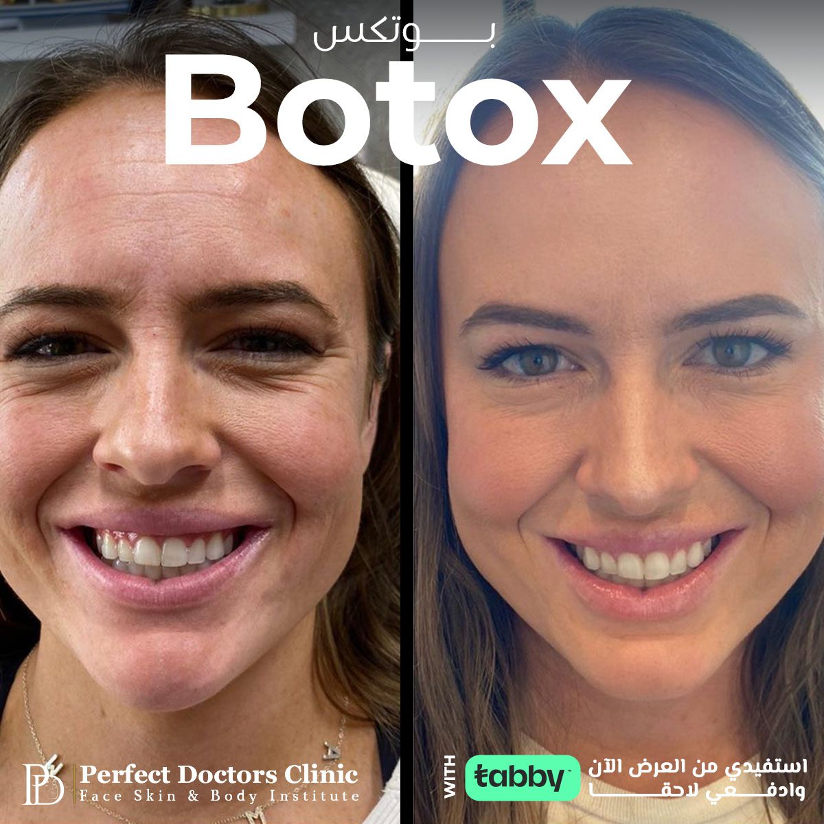 Botox Injections Treatments in Dubai Abu Dhabi - Best Botox Clinic ...