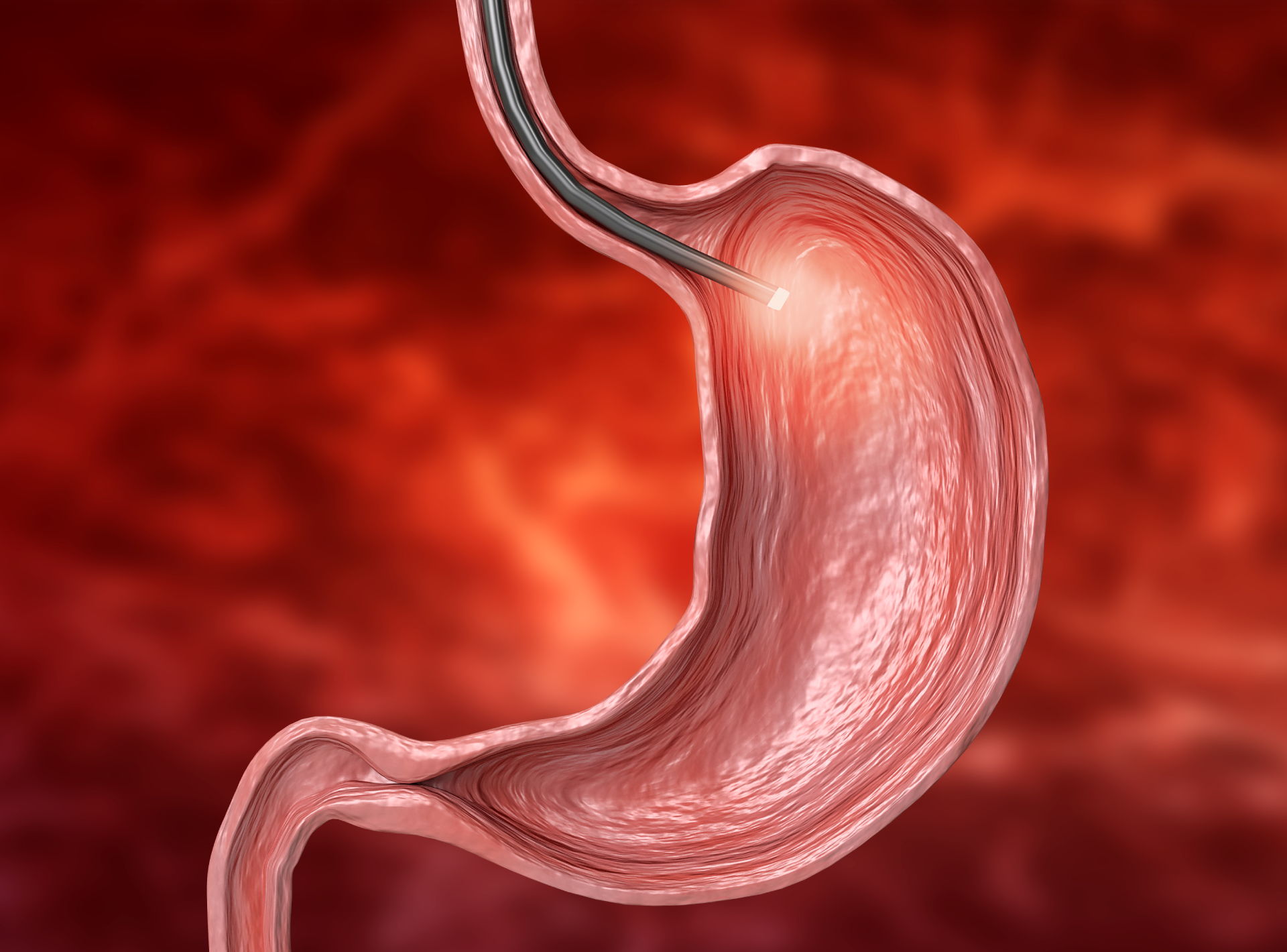Health Improvements After Mini-Gastric Bypass Surgery - Perfect Doctors ...